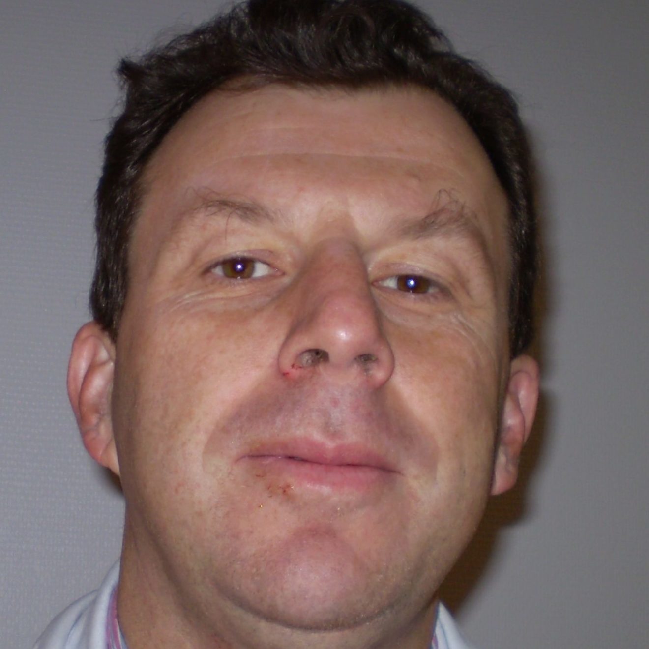 Sarcoïdose – GMIO