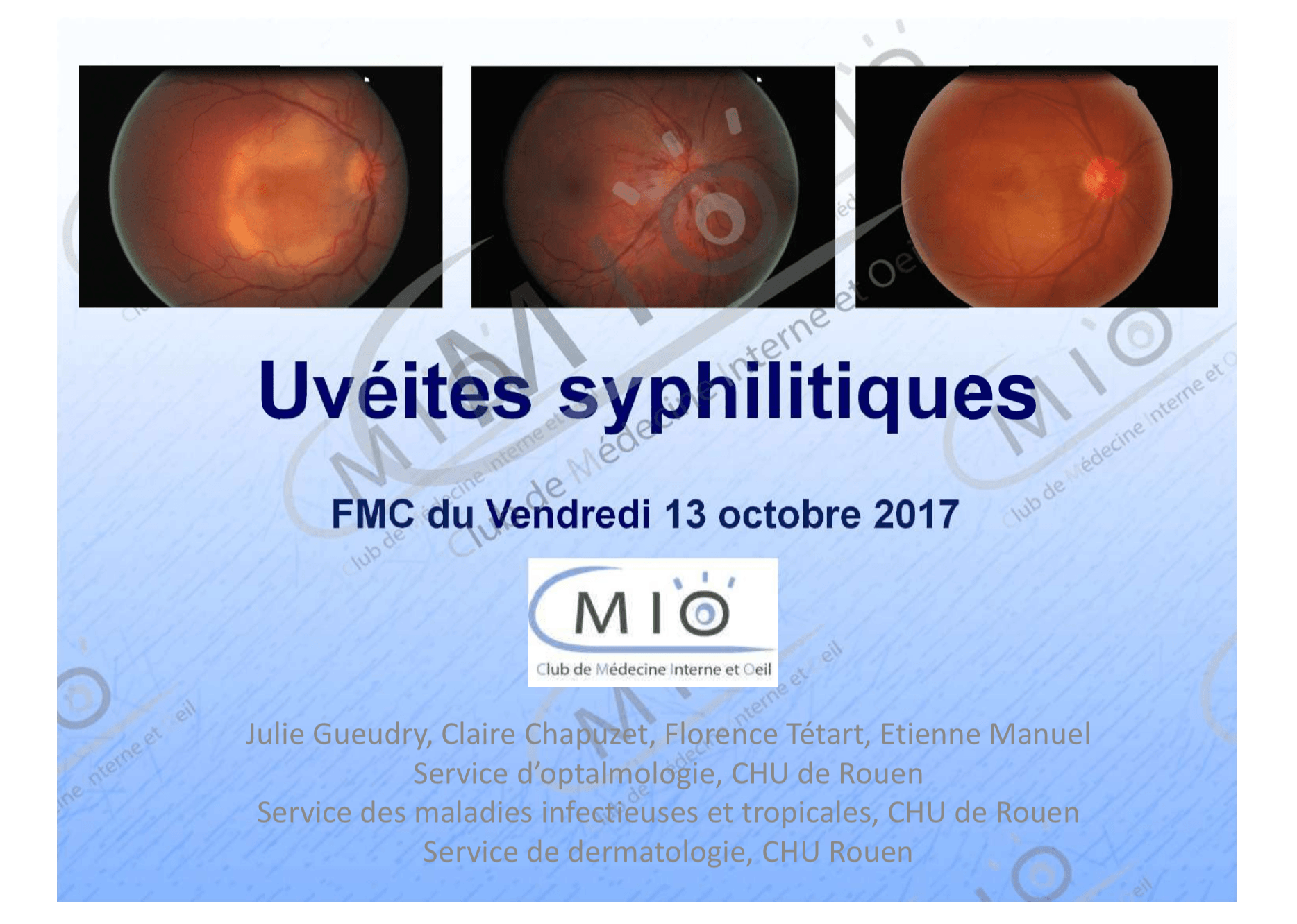 Uvéites syphilitiques – GMIO