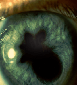 L'uvéite chez l'Homme – GMIO