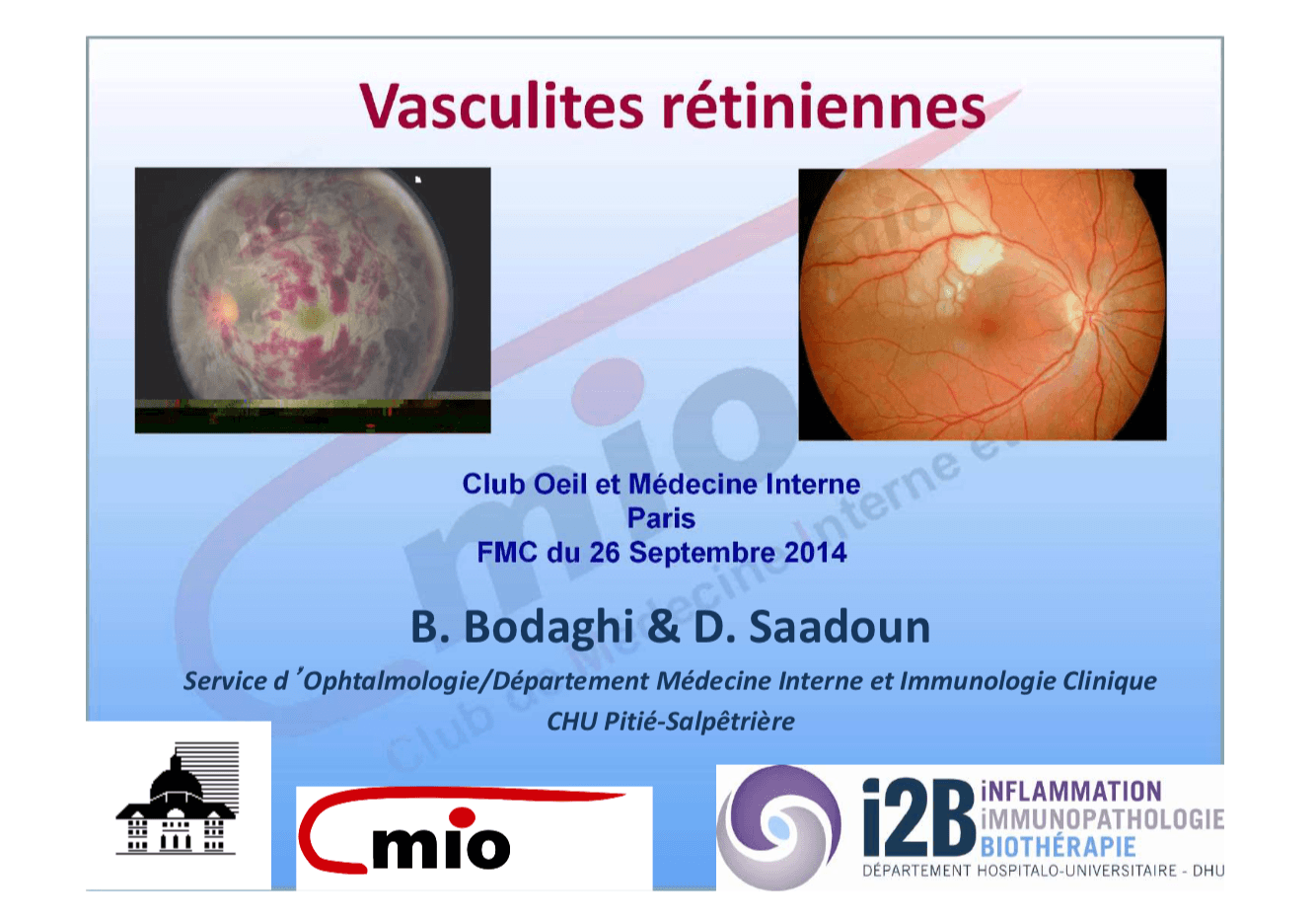 Vascularites rétiniennes – GMIO
